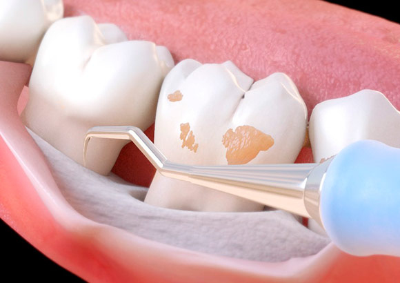 🥇 Periodoncia en Oviedo - Clínica Dental Naranco